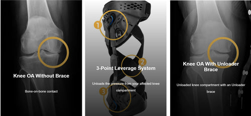 Ossur Unloader One X Knee Brace | OA & Bone-on-Bone Pain Relief | OrthoTape