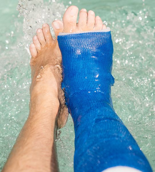 Waterproof Cast broken bones - Leg Cast - Delta Dry
