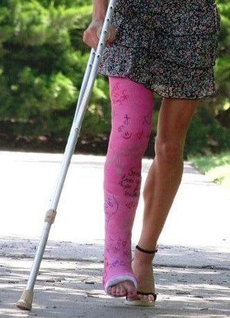 Long Leg Cast - Medical Cast