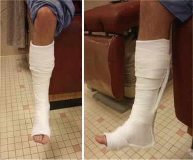 Posterior Ankle Splint Kit - Fiberglass Ankle Sprain & Fracture ...