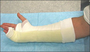Fiberglass Splint Material | Kits for All Kinds of Splints